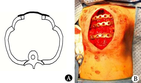 A Schematic Diagram Of Operation And B Operative Picture Download Scientific Diagram
