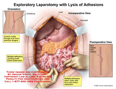 Laparotomy