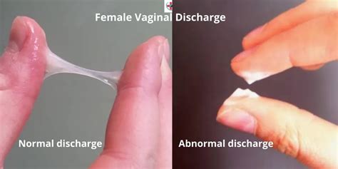 Vaginal Candidiasis Discharge Frontiers Management Of Recurrent