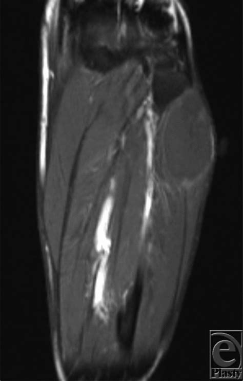 Ganglion Cyst Proximal Tibiofibular Articulation