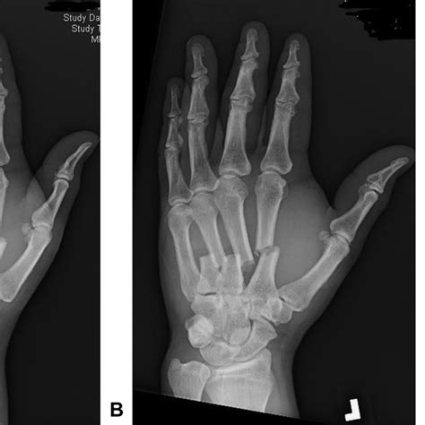 Pdf Antegrade Intramedullary Screw Fixation A Novel Approach To Metacarpal Fractures