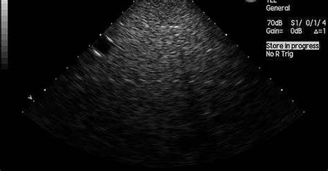 Acuson Siemens V5ms Cardiac Phased Array Probe Image Degradation Album On Imgur