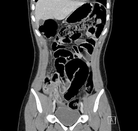 Coronal Ct Image Demonstrating The Inf Lamed Appendix Containing Coronal Ct Image Demonstrating The Inf Lamed Appendix Containing