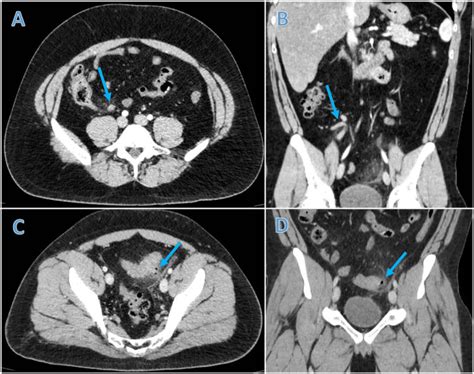 Coexistence Of Acute Appendicitis And Sigmoid Diverticulitis Pmc