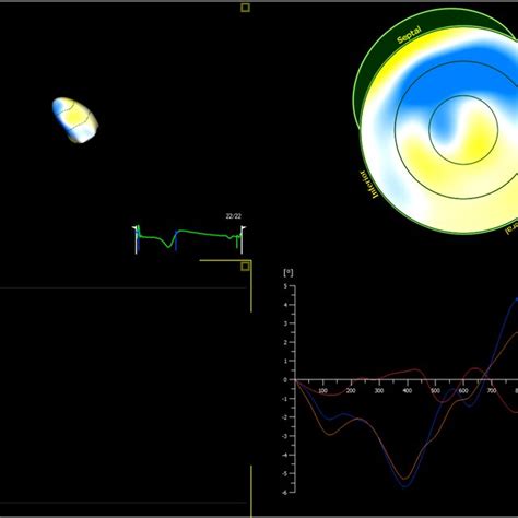 Three‐dimensional Echocardiographic Assessment Of Left Ventricular Download Scientific Diagram
