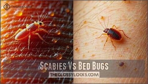 Scabies Vs Bed Bugs Know Difference