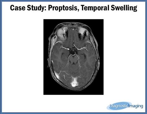Proptosis Temporal Swelling