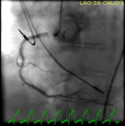 Can You See Through This Paced Rhythm Dr Smiths Ecg Blog