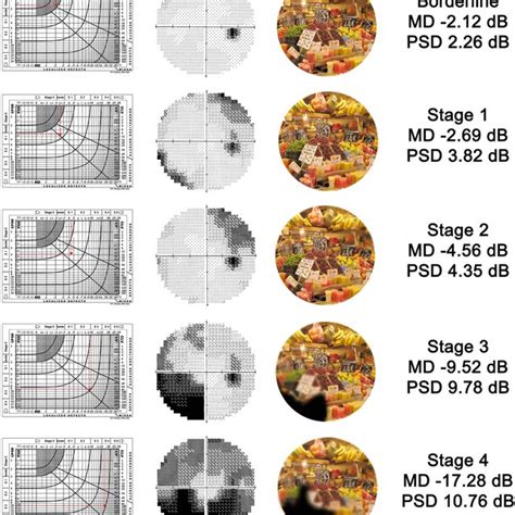 Glaucoma Symptom Scale Gss Questionnaire Scores By Stage According To
