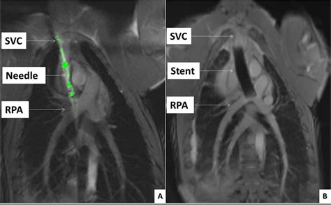A Depicts Real Time Mri Needle Access Of Adjacent Vessels Superior