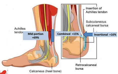 Achilles Tendinitis Icd 10