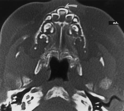 Pyriform Aperture Stenosis Radiology