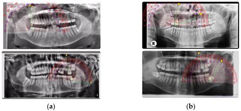 Maxillary And Mandibular Third Molars Impaction With Associated Pathologies In A North Cyprus