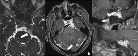 Role Of Magnetic Resonance Imaging In Trigeminal Neuralgia Pdf Download Available