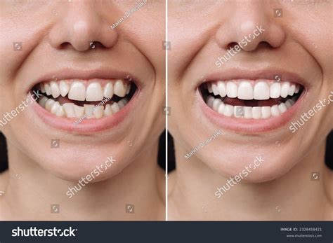 Veneers Before And After Crooked Teeth Turkey Teeth Before And After