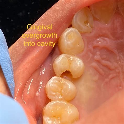 Simple Class 2 Composite Filling Done Lai Dental Clinic Facebook