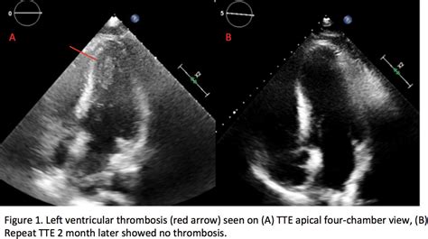 A Rare Cause Of Left Ventricular Thrombus Cardiomyopathy And