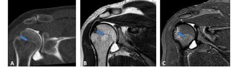 Figure 6 From Shoulder Joint Instability Evaluation By Ct Arthrography
