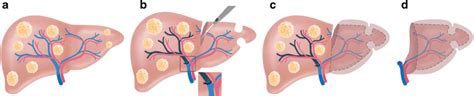 As An Alternative To A Conventional Tsh Associating Liver Partition Download Scientific