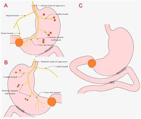 Exploring The Safety And Efficacy Of Stomach Partitioning Gastrojejunostomy With Distal