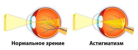Лазерная коррекция астигматизма - клиника "Clean View"