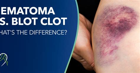 Contusion Vs Hematoma Hematoma Vs Bruise How To Tell The Difference