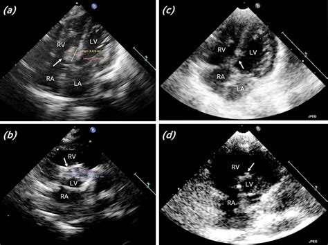 Apex Five Chamber A And Parasternal Short Axis B Views Of Tte