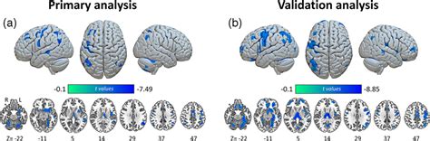 Group Differences In Vbm A Primary And B Validation Results Of