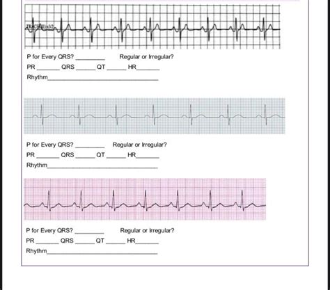 Solved P For Every Qrs Regular Or Irregular Pr Qrs Qt Hr