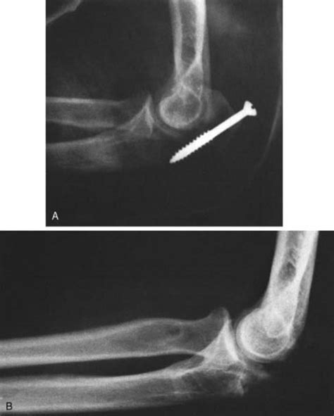 Nonunion Of The Olecranon And Proximal Ulna Clinical Gate