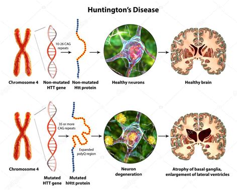 Genesis molecular de la enfermedad de Huntington ilustración 3D La expansión de la secuencia