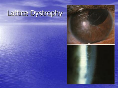 Ppt Corneal Dystrophies And Degenerations Powerpoint Presentation
