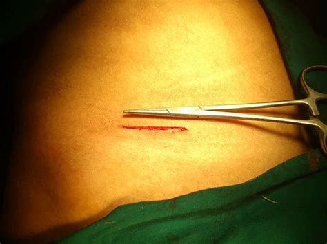 Acute Appendicitis Dr Tamjeed Alam