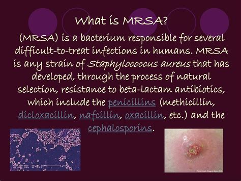 Ppt Methicillin Resistant Staphylococcus Aureus Mrsa Powerpoint Presentation Id 2535654