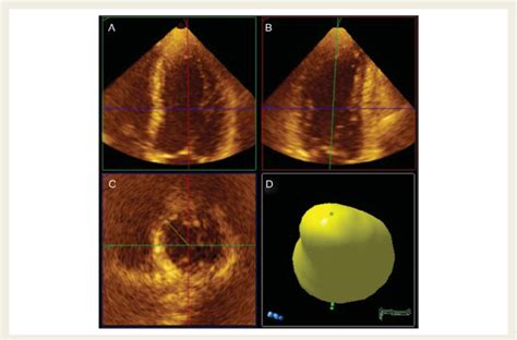 Real Time Three Dimensional Echocardiography Image Analysis Apical Download Scientific Diagram