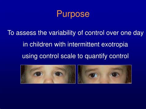 Ppt Intraday Variability Of Control In Intermittent Exotropia