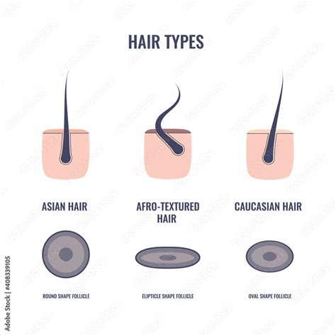 Ingrown Hair Diagram