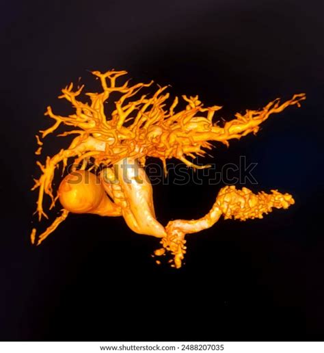 Magnetic Resonance Cholangiopancreatography Mrcp Showing Gallbladder Stock Illustration