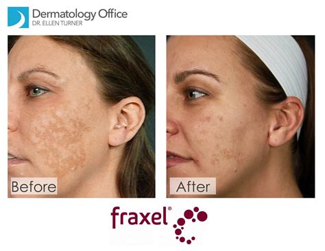 Fractional Laser Skin Resurfacing Donvoj