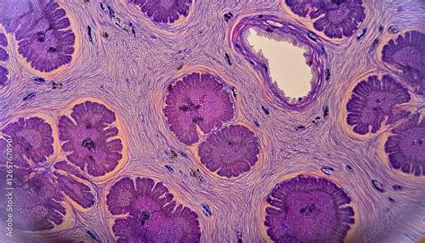 A Microscopic Examination Of Abnormal Lymph Node Tissue Reveals A