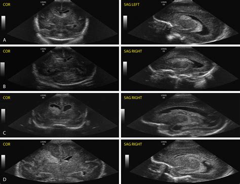 Intraventricular Hemorrhage In The Neonate Clinical Tree
