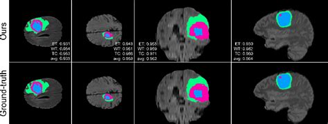 Figure 1 From Cross Modality Deep Feature Learning For Brain Tumor