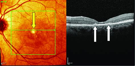 Oct Left Eye Case 3 Oct Showed Bilateral Foveal Atrophy White Download Scientific Diagram
