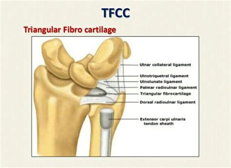 The Triangular Fibrocartilage Complex Tfcc Slide Vineet Srivastava Carpal Tunnel Surgery