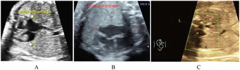 Fetal Echocardiogram Normal And Abnormal Intechopen