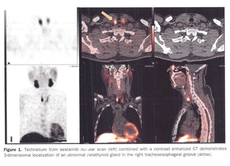 Parathyroid Scan Dssurgery