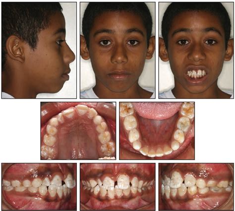 Crossbite Braces Before After