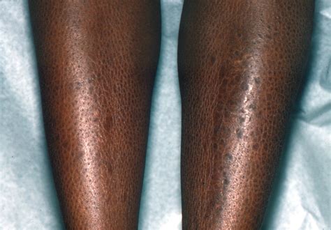 Ichthyosis Vulgaris