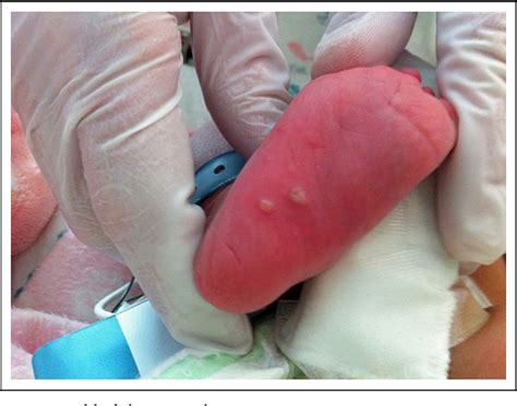 Figure 2 From Vesicular Rash In A 28 Day Old Girl Semantic Scholar