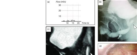 A Preoperative Uroflowmetry Results Indicating Severe Dysuria B